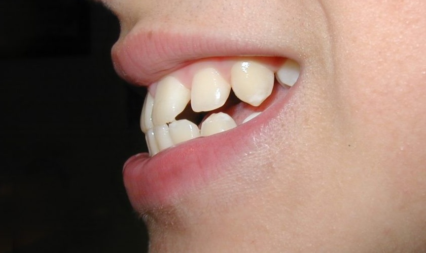 What is the best way to fix the overbite?