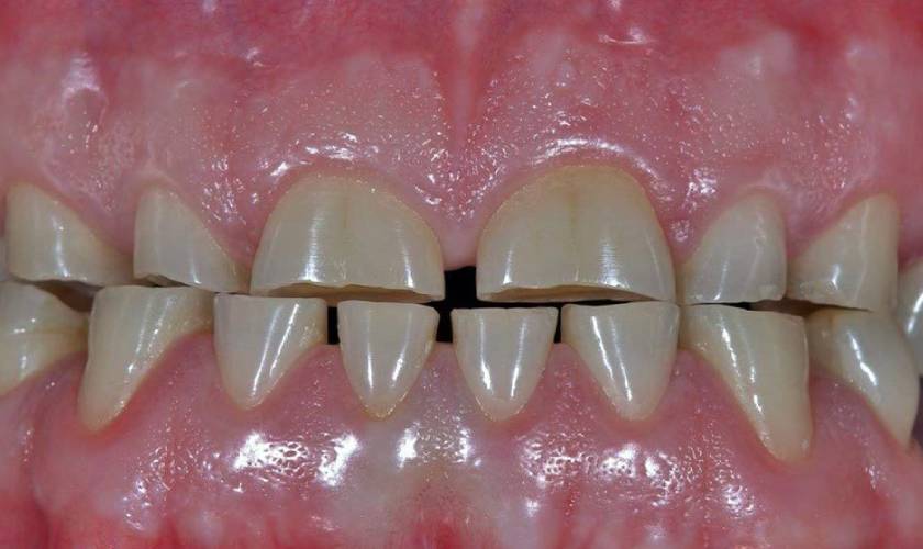 Abrasion Vs Attrition