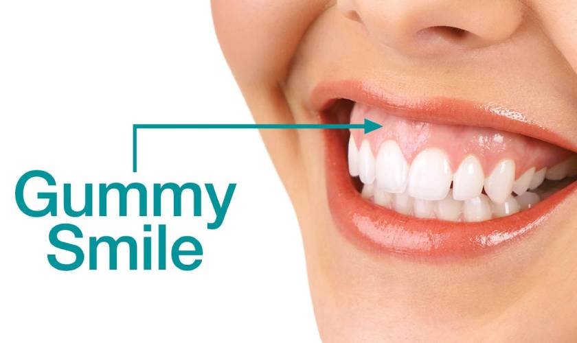 The gummy smile: Excessive gingival display or delayed passive eruption