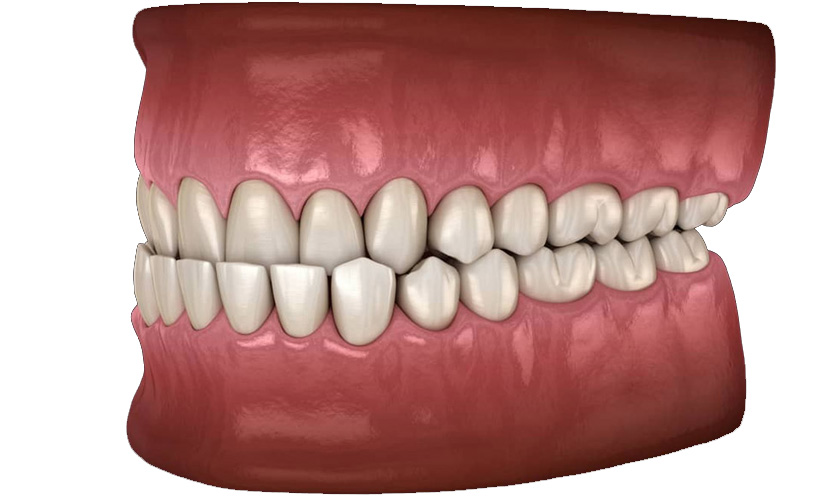 Overjet Dental Orthodontics Newcastle The Difference Between An