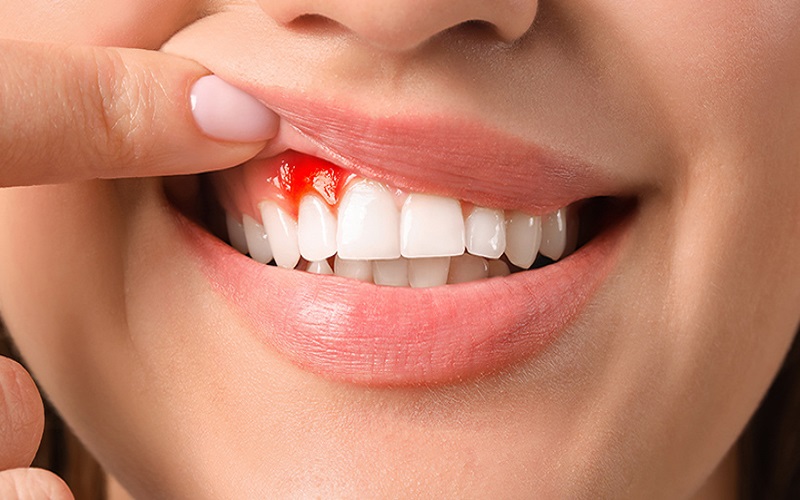 Causes of bleeding gums and treatment